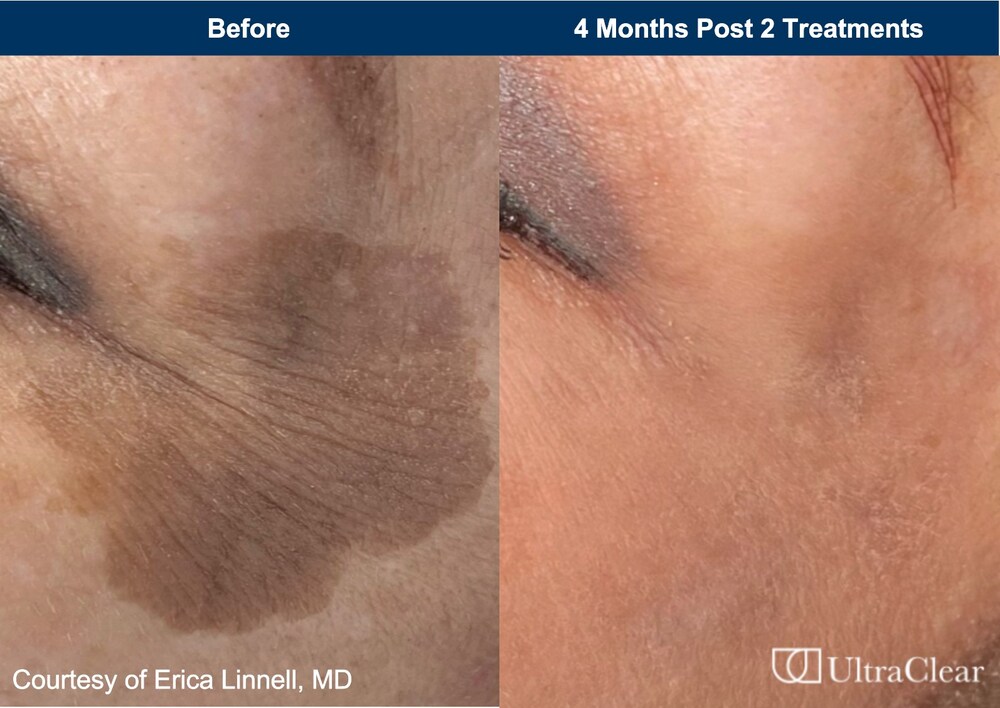 UltraClear™' Laser Services - Laser Dermatology