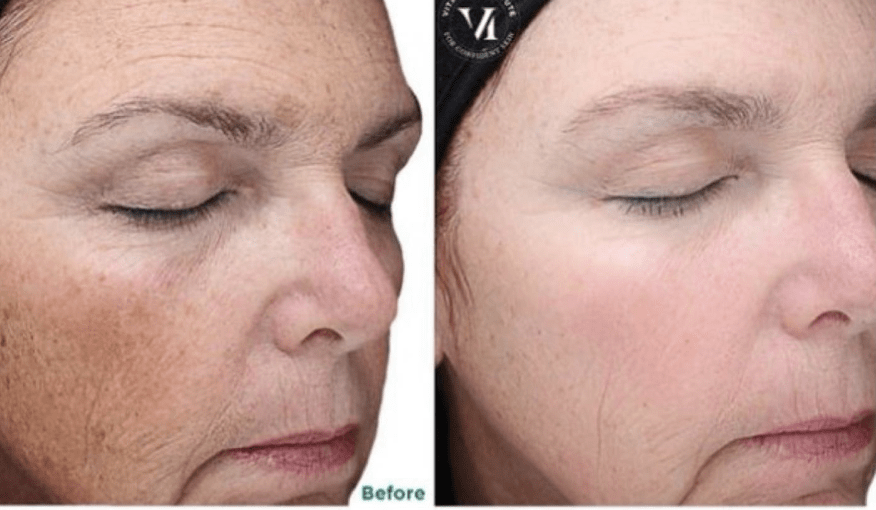 Reveal Radiant Skin with a VI Peel | Genesis Dermatology